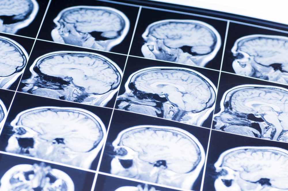What is the Difference Between a Concussion and a Traumatic Brain Injury? What is the Difference Between a Concussion and a Traumatic Brain Injury?