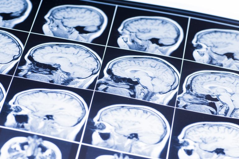 What is the Difference Between a Concussion and a Traumatic Brain Injury?